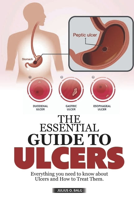 The Essential Guide to Ulcers: Everything You Nand needs to Know about ...