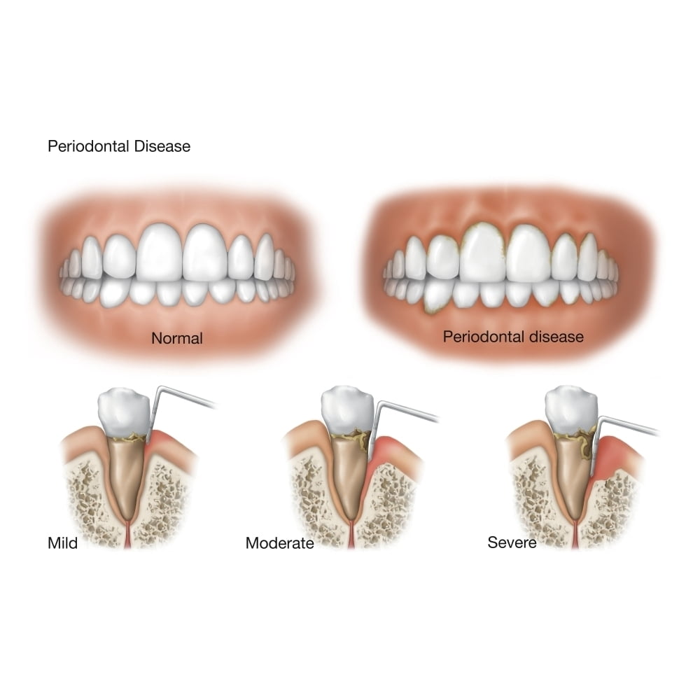 Three stages of periodontal disease. Poster Print by TriFocal ...