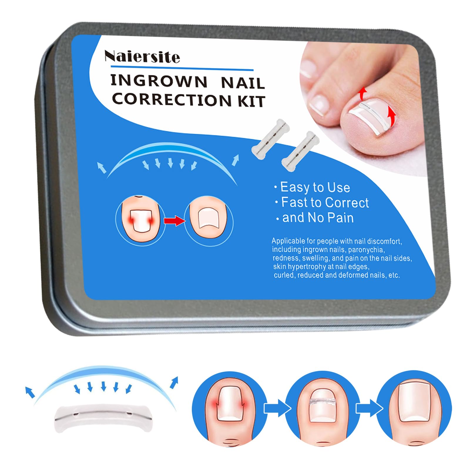 Titanium Alloy Silicone Ingrown MMF7 Toenail Treatment, Designed for ...