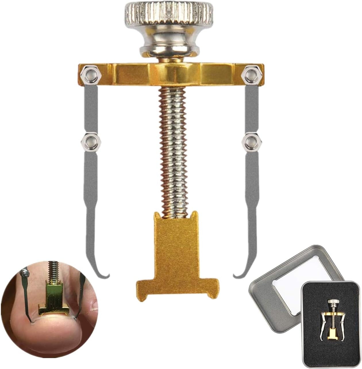 Toenail Correction Kit, Painlessly Corrects Ingrown Toenails With Ease ...