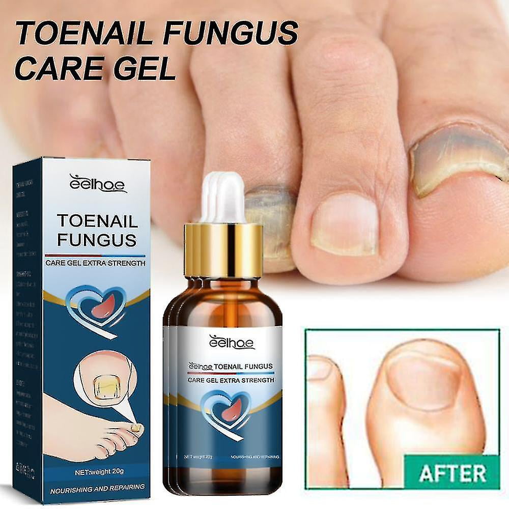 Toenail Fungus Gel Repair Hand Foot Nail Fingernails Soft Nails ...