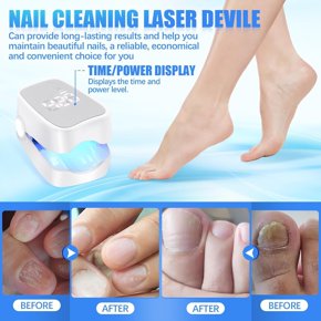 Fungal Toenail Laser Treatment