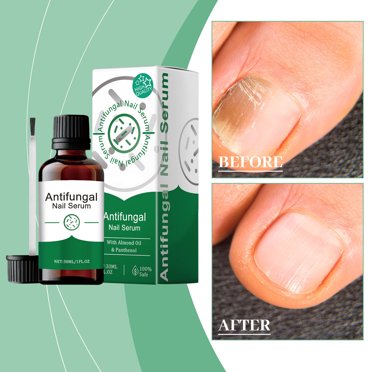 German Toenail Care oil for Removing Paronychia, Nail Care and ...
