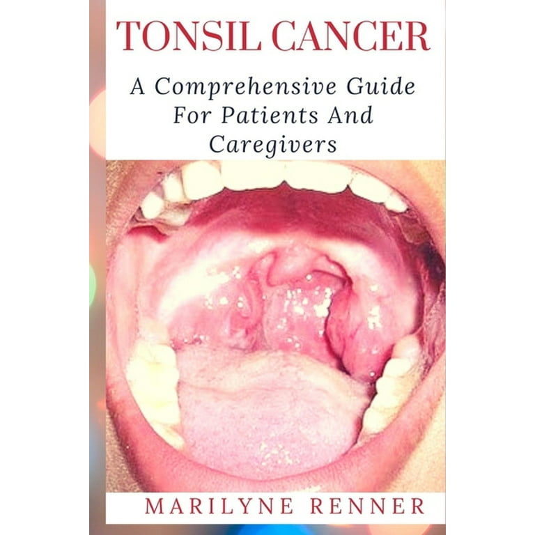 Lingual Tonsil Cancer Pictures Laryngeal Cancer Barrow Neurological