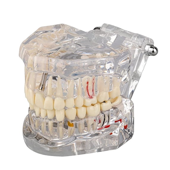 Transparent Disease Teeth Model with Dental Implant Bridge, Dental ...