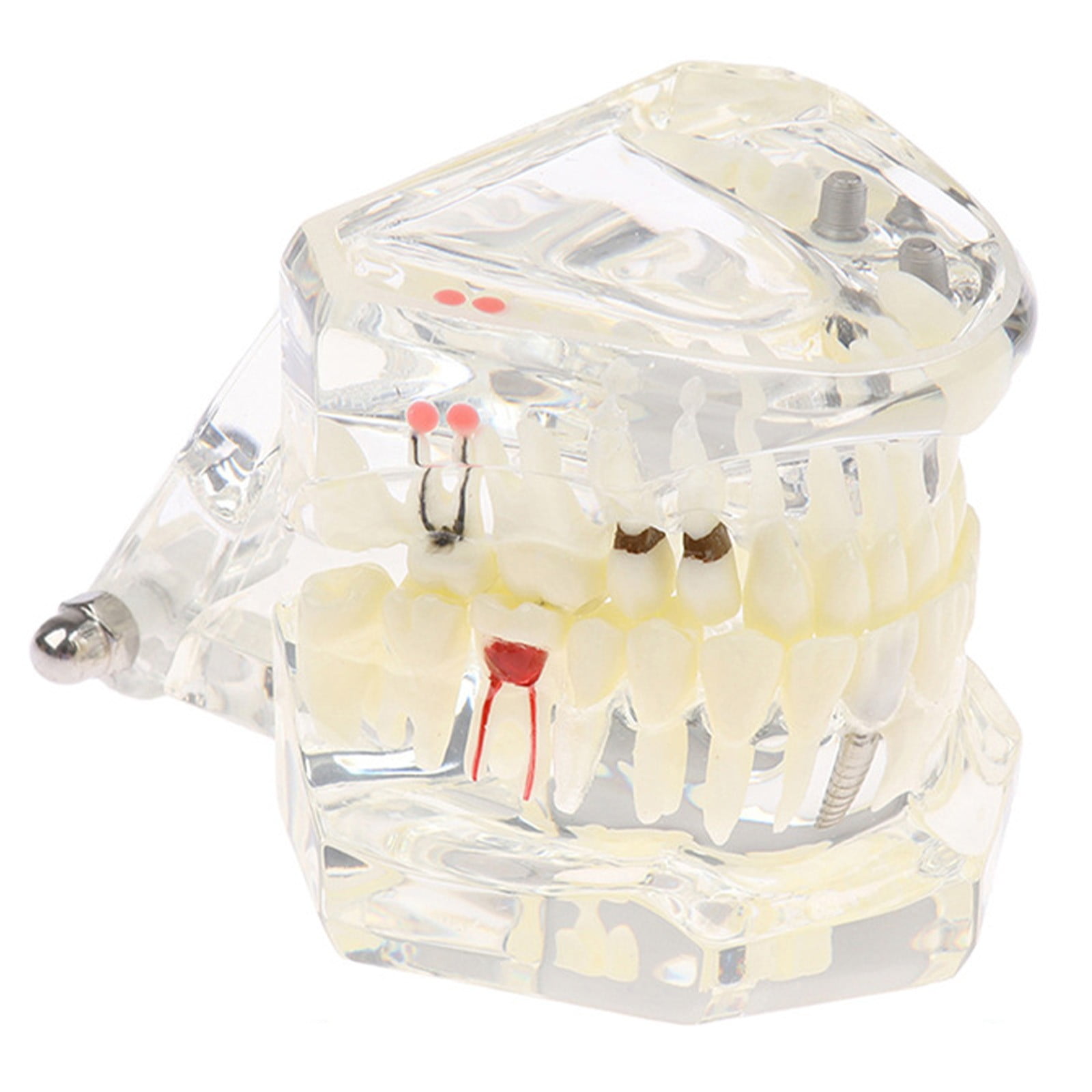 Transparent Implant Teeth Model with Removable Pathological Teeth for ...