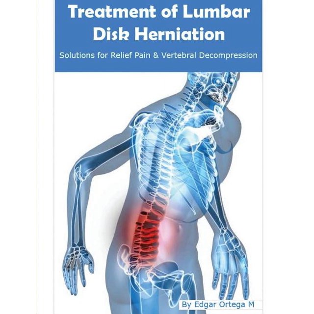 Treatment of Lumbar Disk Herniation: Back Pain Relief and Herniated Discs Solutions, (Paperback ...