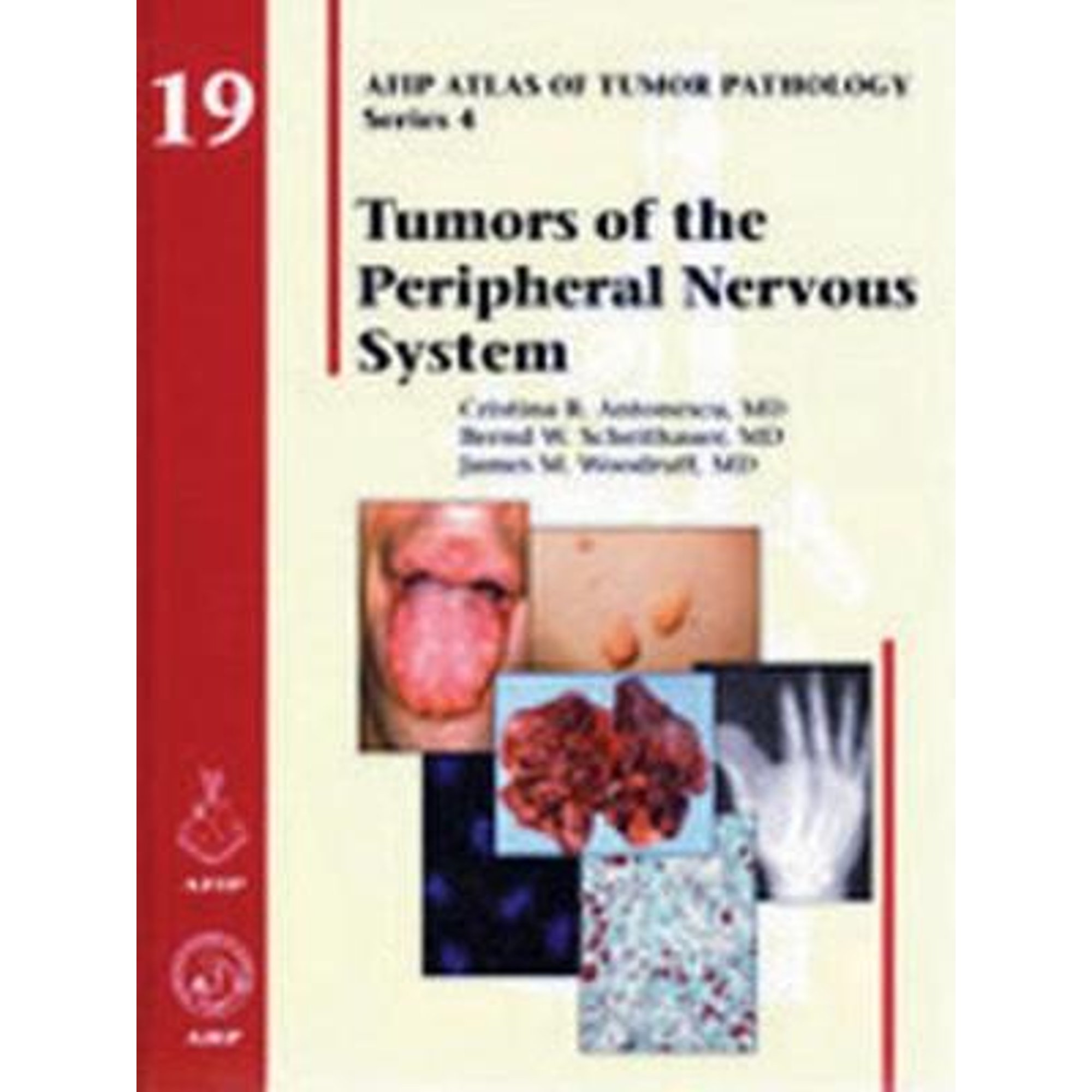 Pre-Owned Tumors of the Peripheral Nervous System (Hardcover) by ...