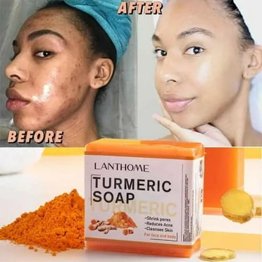 AMVital Organic Turmeric Soap Bar- Removing Acne, Dark Spots for Smooth ...