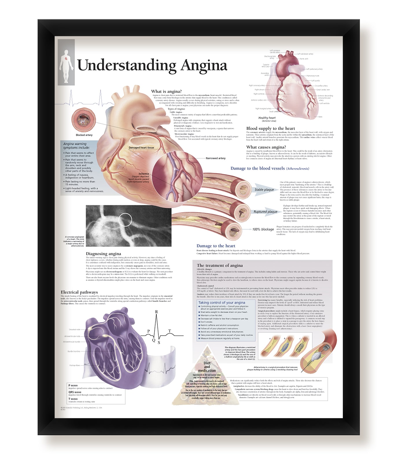 Understanding Angina Framed Medical Educational Informational Poster ...
