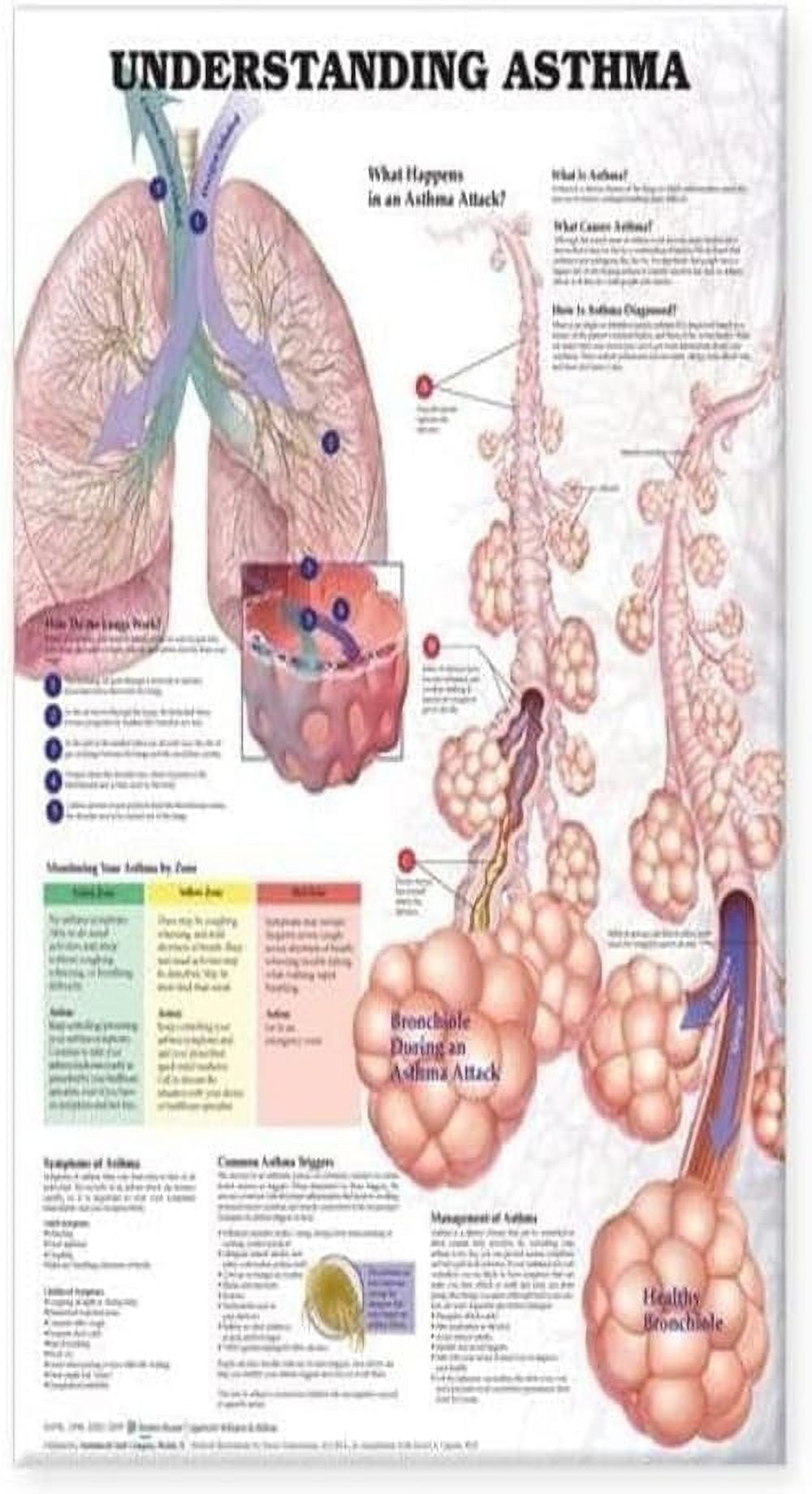 Understanding Asthma Anatomical Chart - Walmart.com Understanding Asthma Anatomical Chart - Walmart.com