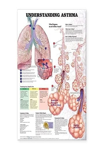 Understanding Asthma Anatomical Chart - Walmart.com Understanding Asthma Anatomical Chart - Walmart.com