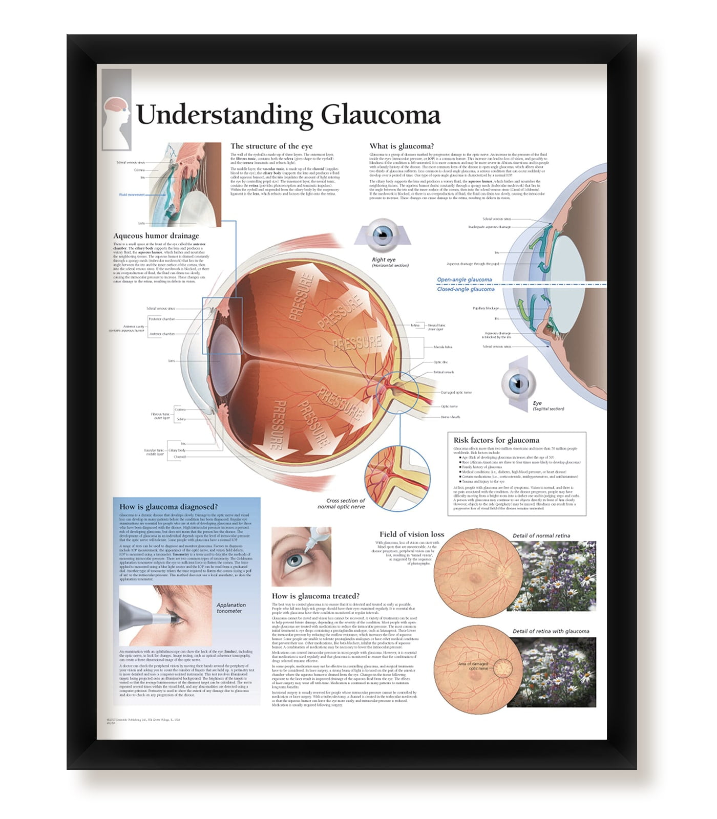 Understanding Glaucoma Framed Medical Educational Informational Poster ...