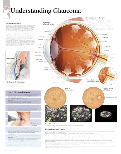 Understanding Glaucoma chart : Wall Chart (Wallchart) - Walmart.com