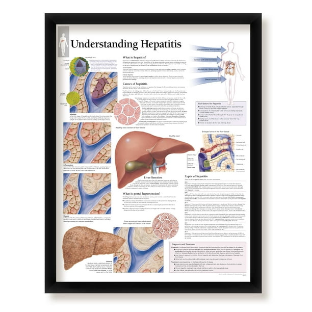 Understanding Hepatitis Framed Medical Educational Informational Poster ...