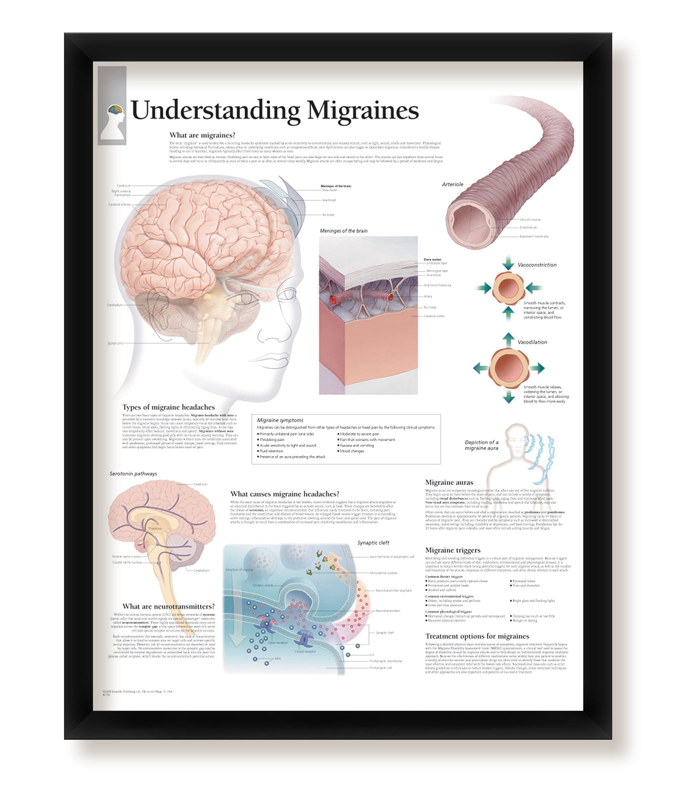 Understanding Migraines Framed Medical Educational Informational Poster ...