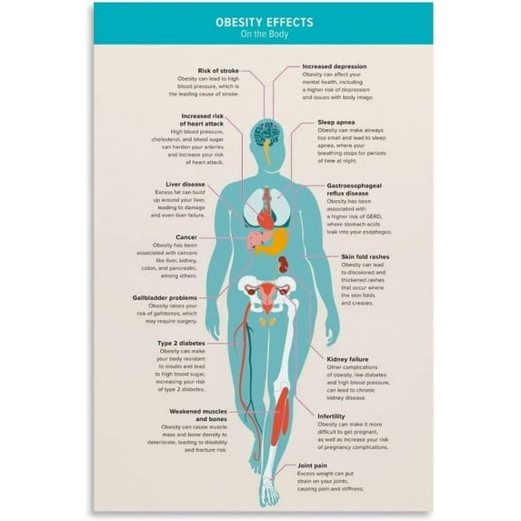 Understanding Obesity Poster Obesity Is Bad for Human Health Poster (3 ...