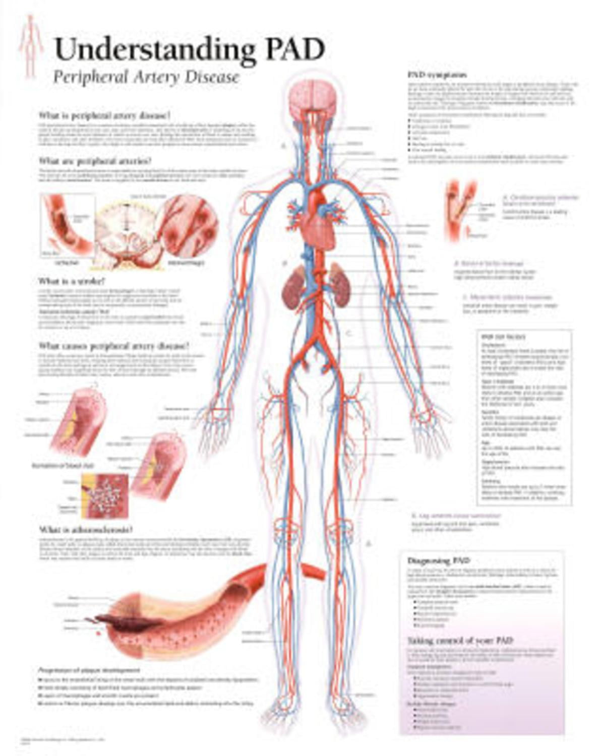 Understanding PAD Educational Disease Chart Poster Poster by Unknown ...