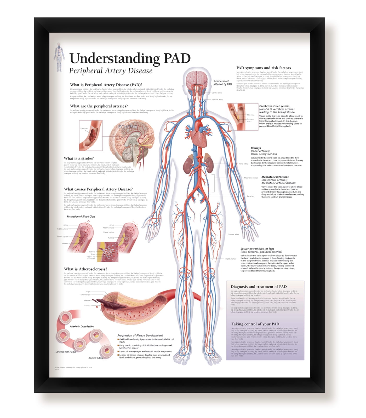 Understanding PAD Peripheral Artery Disease Framed Medical Educational ...