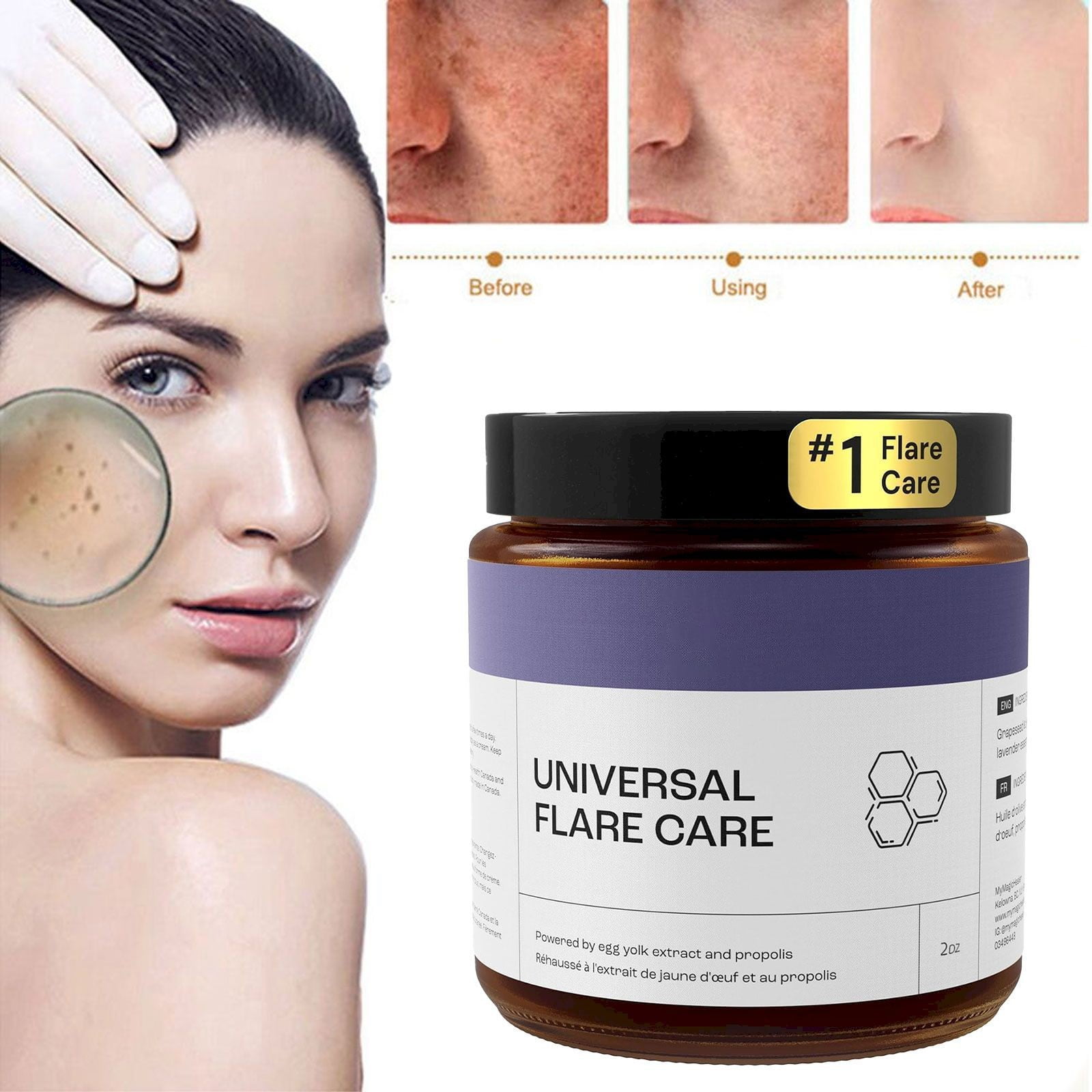 Universal Flare Care | Relief for 97% of Skin Issues | Cysts, Inflamed Skin, Hidradenitis ...