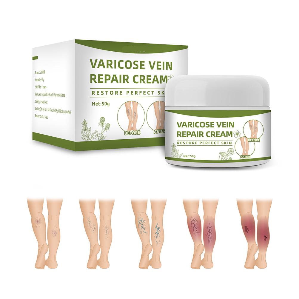 Varicose Veins Cream Natural Ointment for Varicose and Spider Veins ...