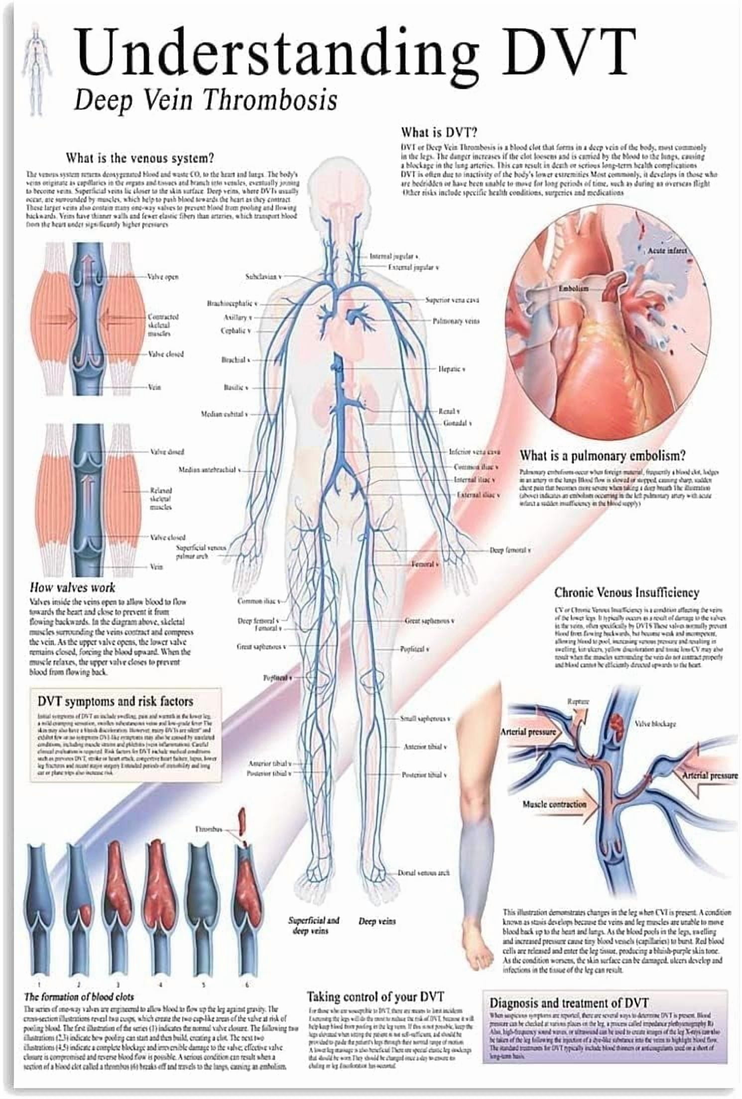 Vascular Knowledge Metal Signs Wall Decor Understanding Dvt Deep Vein ...