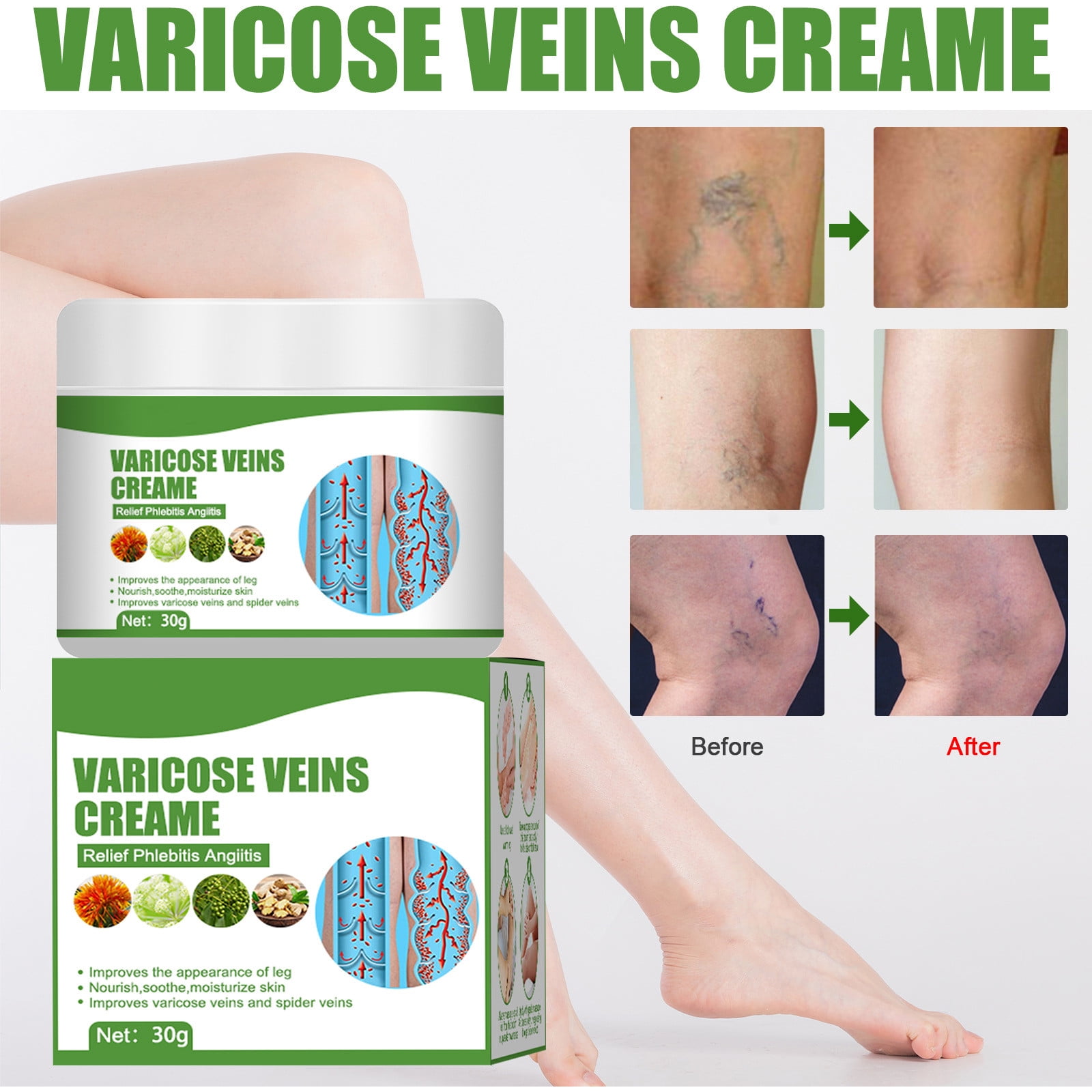 Venoheal Varicose Vein Ease Paste Varicose Veins Paste Varicose And