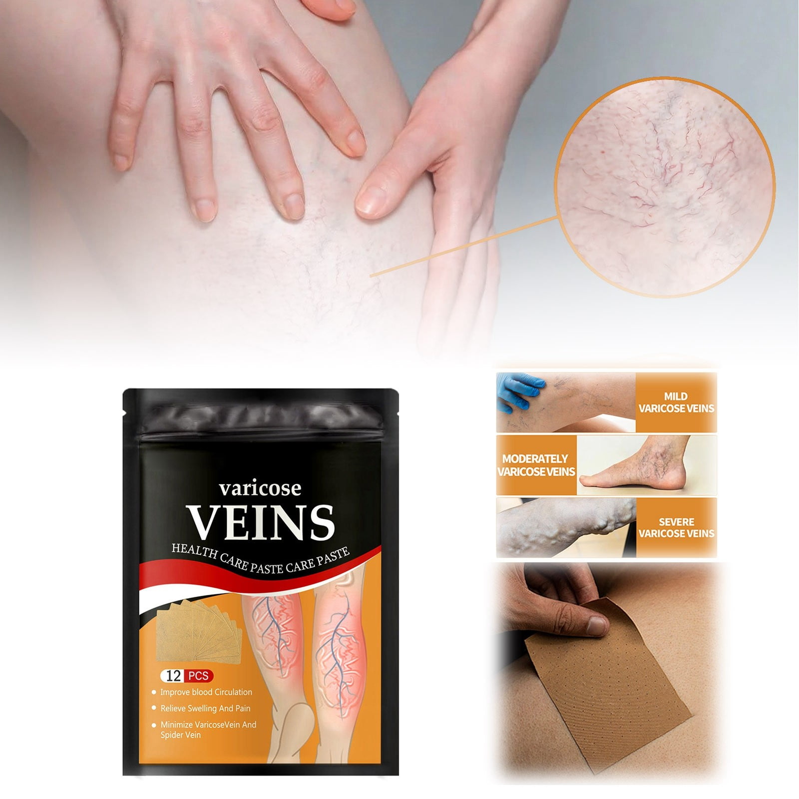 Venous Series Soreness Swelling Varicose Earthworm Legs Bulging Veins ...
