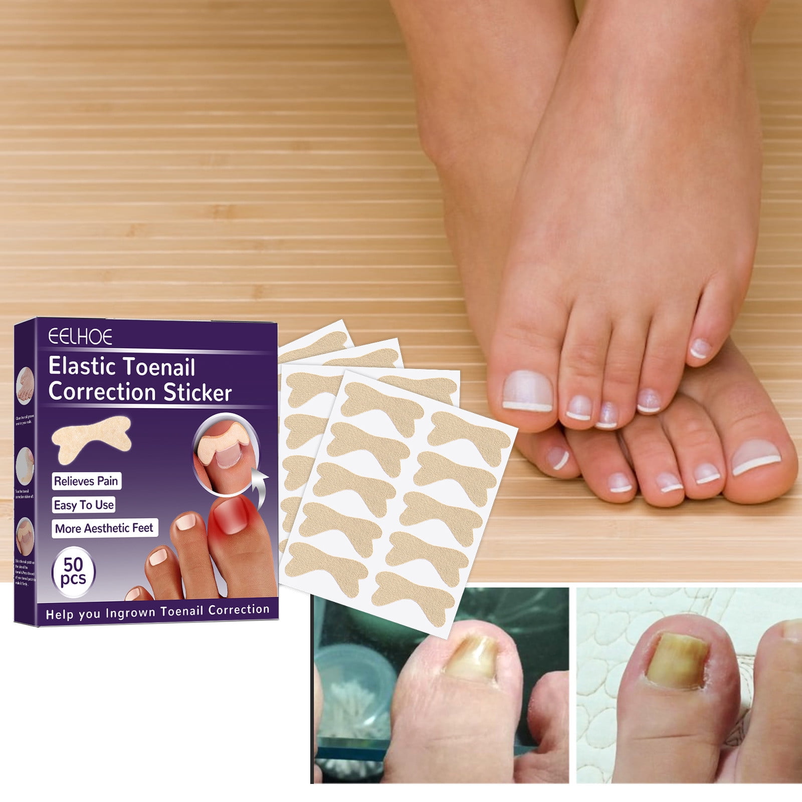 Vrorvz Ingrown Toenail Correction Tool Long Term Treatment Kit with ...