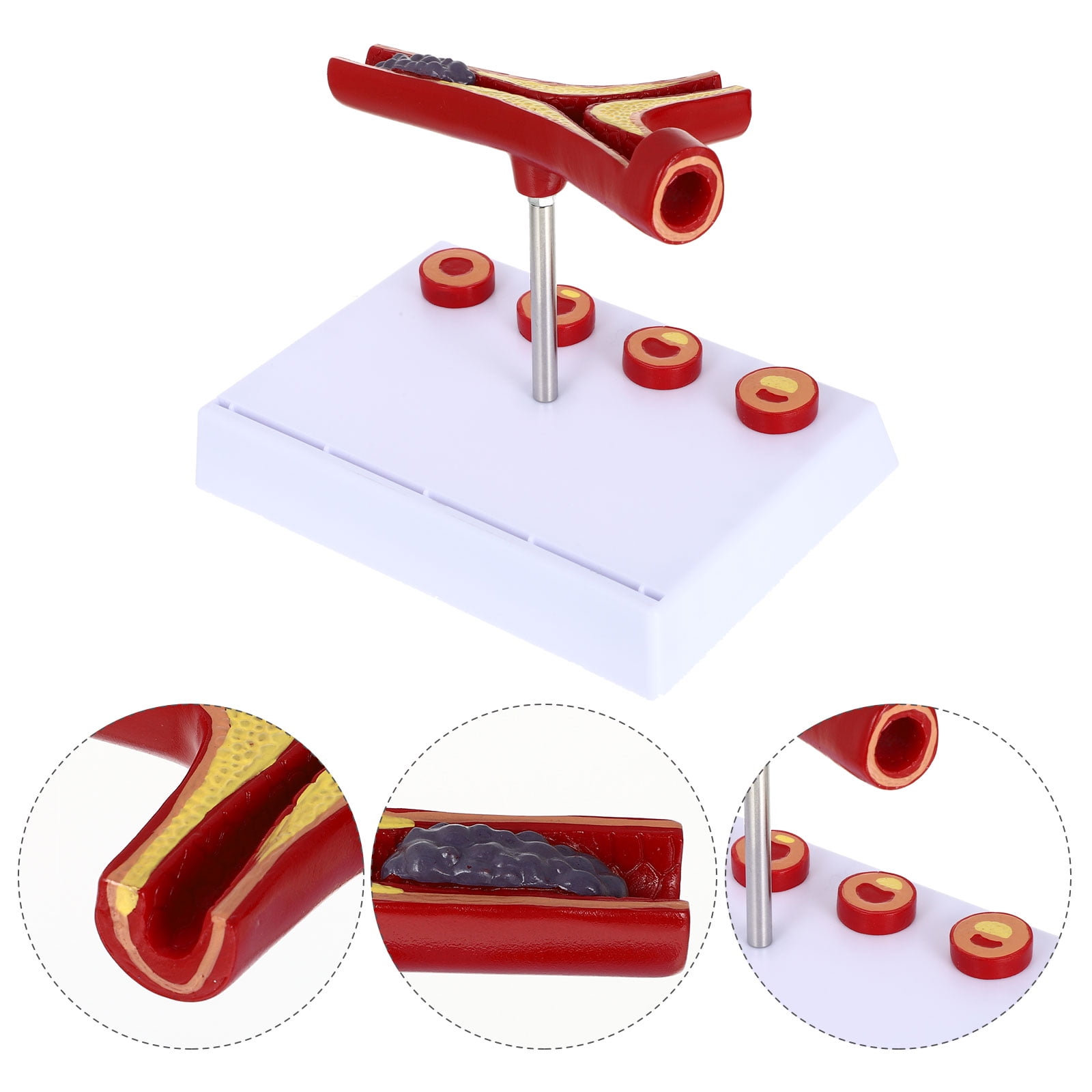 WHAMVOX Human Atherosclerosis Anatomical Model for Display Made of PVC ...
