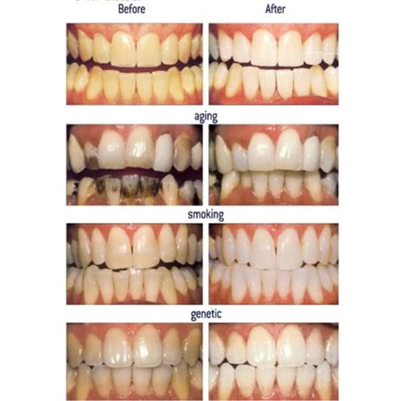 Teeth Whitening Strips in Teeth Whitening - Walmart.com