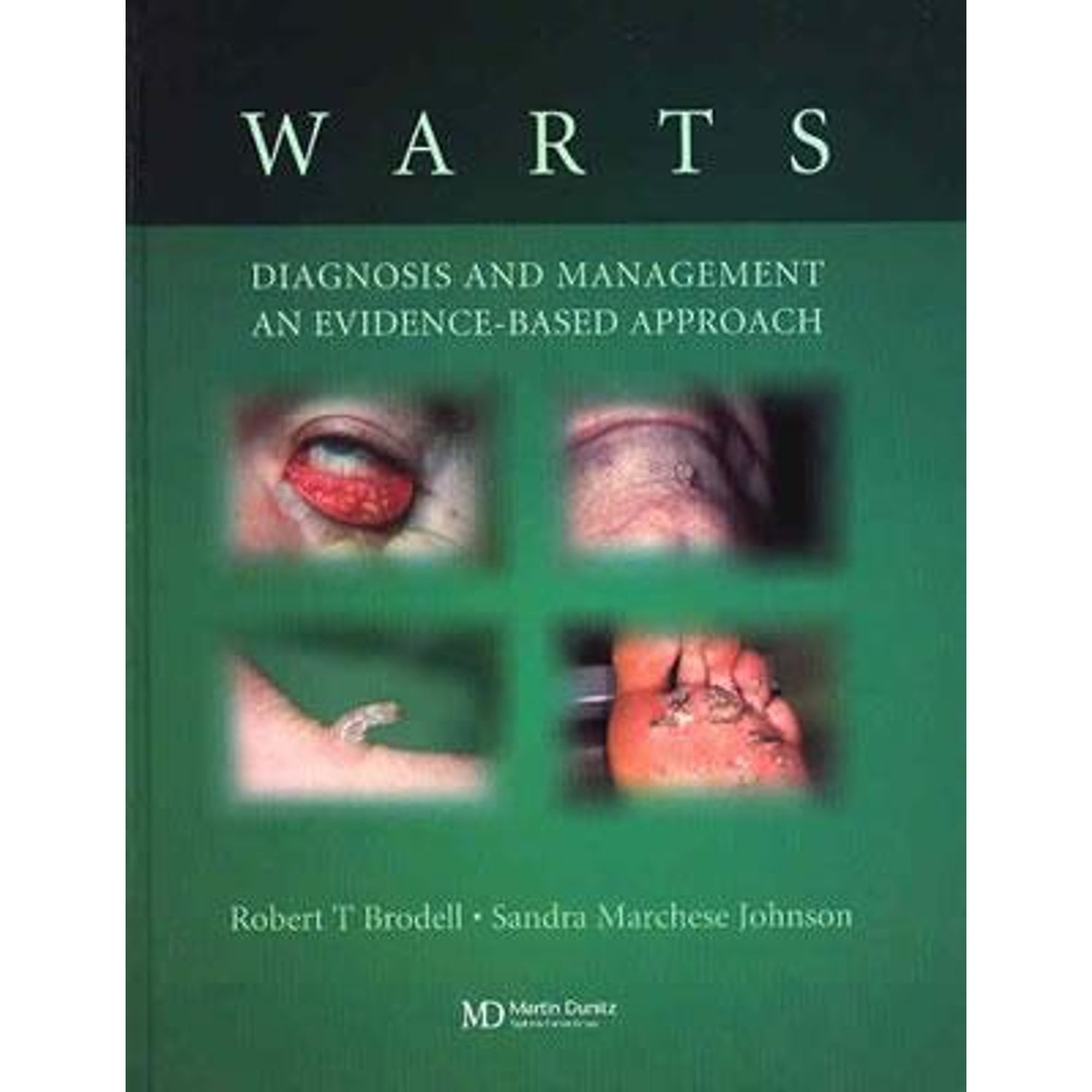 Warts: Diagnosis and Management: An Evidence-Based Approach (Hardcover ...
