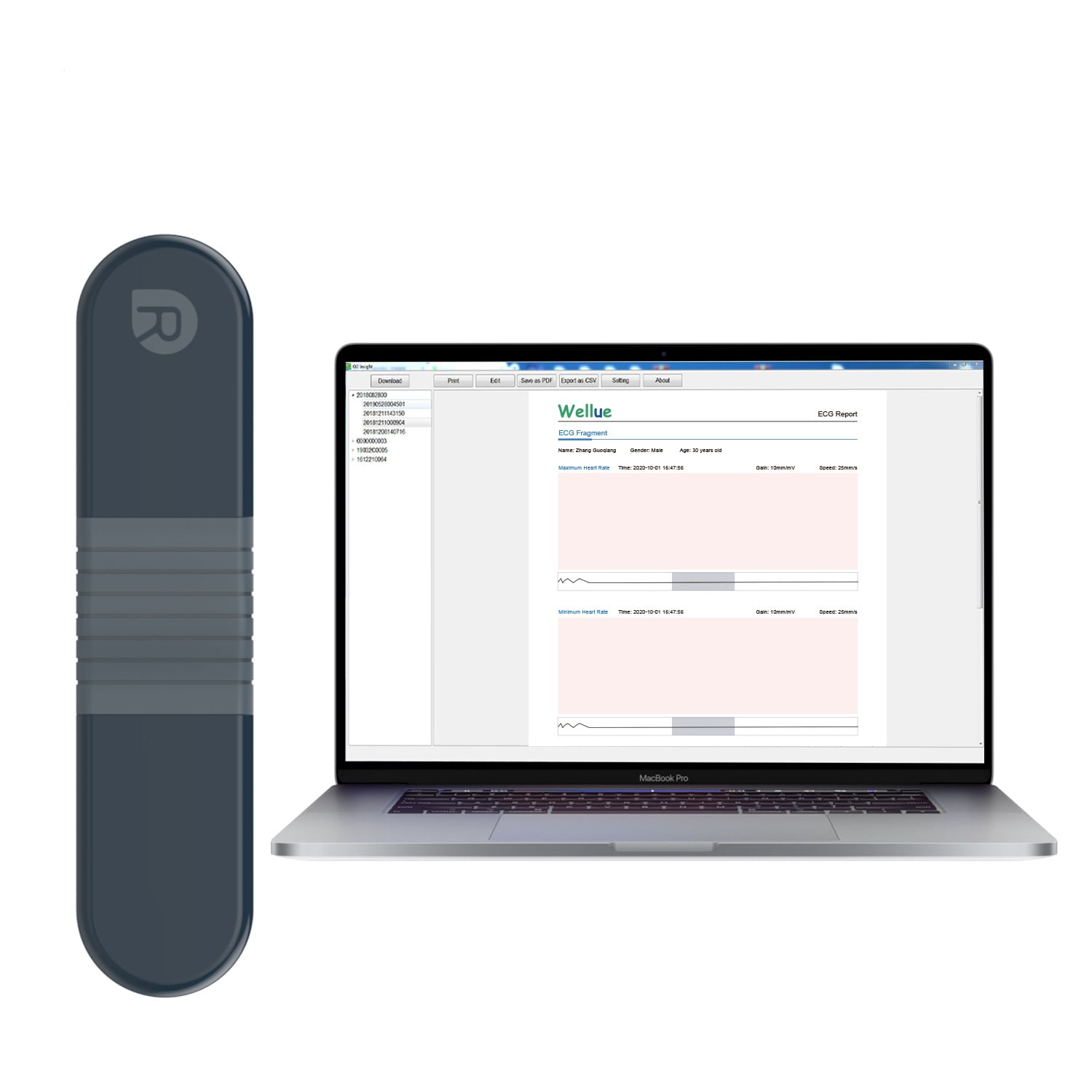 Wellue Heart Rate Monitor,24 Hours AI ECG Monitor with Free AI Analysis ...