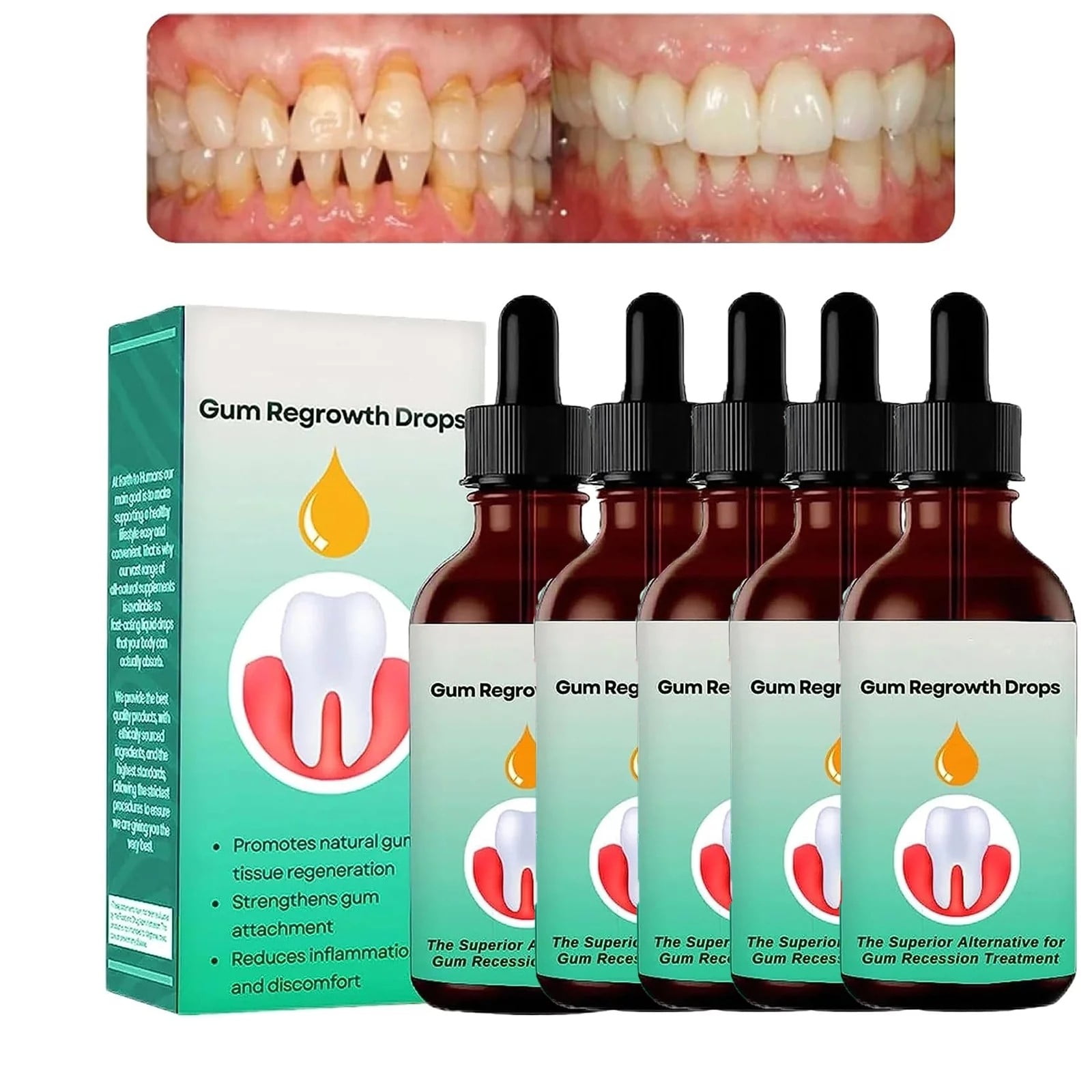 Wentin 5packs Gum Drops Gum Recession Tooth And Gum Oil Extraction Easy ...