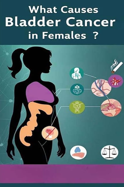 What Causes Bladder Cancer in Females?: There are many potential causes ...