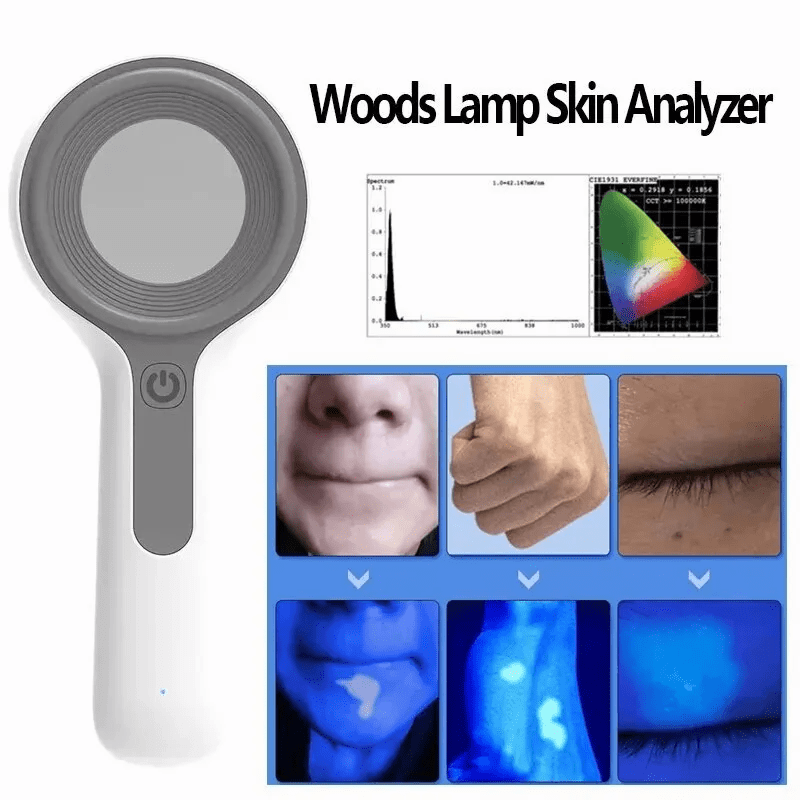 Woods Lamp Skin UV Analyzer Body Skin Diagnostic Tool LED Lamp Light ...