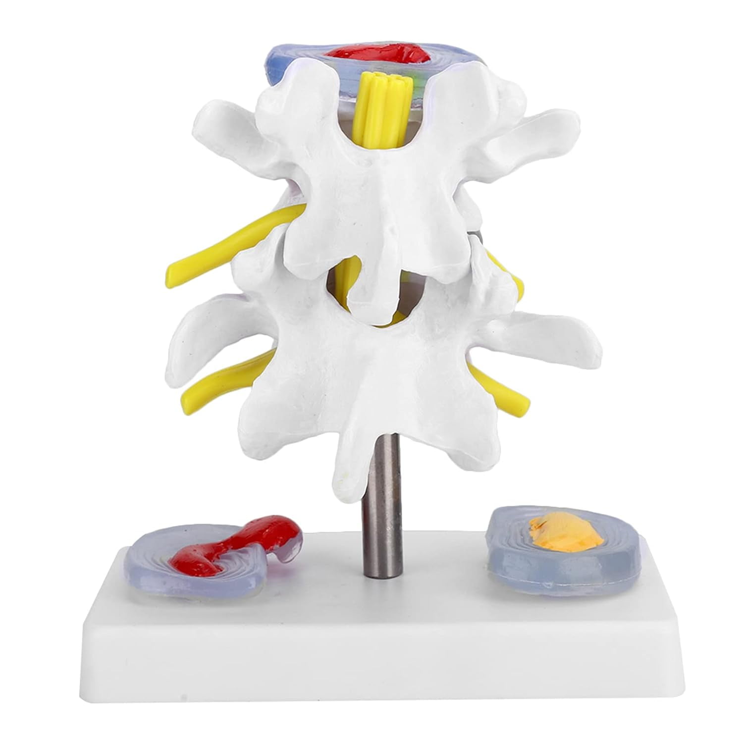 XD3-Human Spine Model, Vivid Lumbar Disc Herniation Model, Human ...