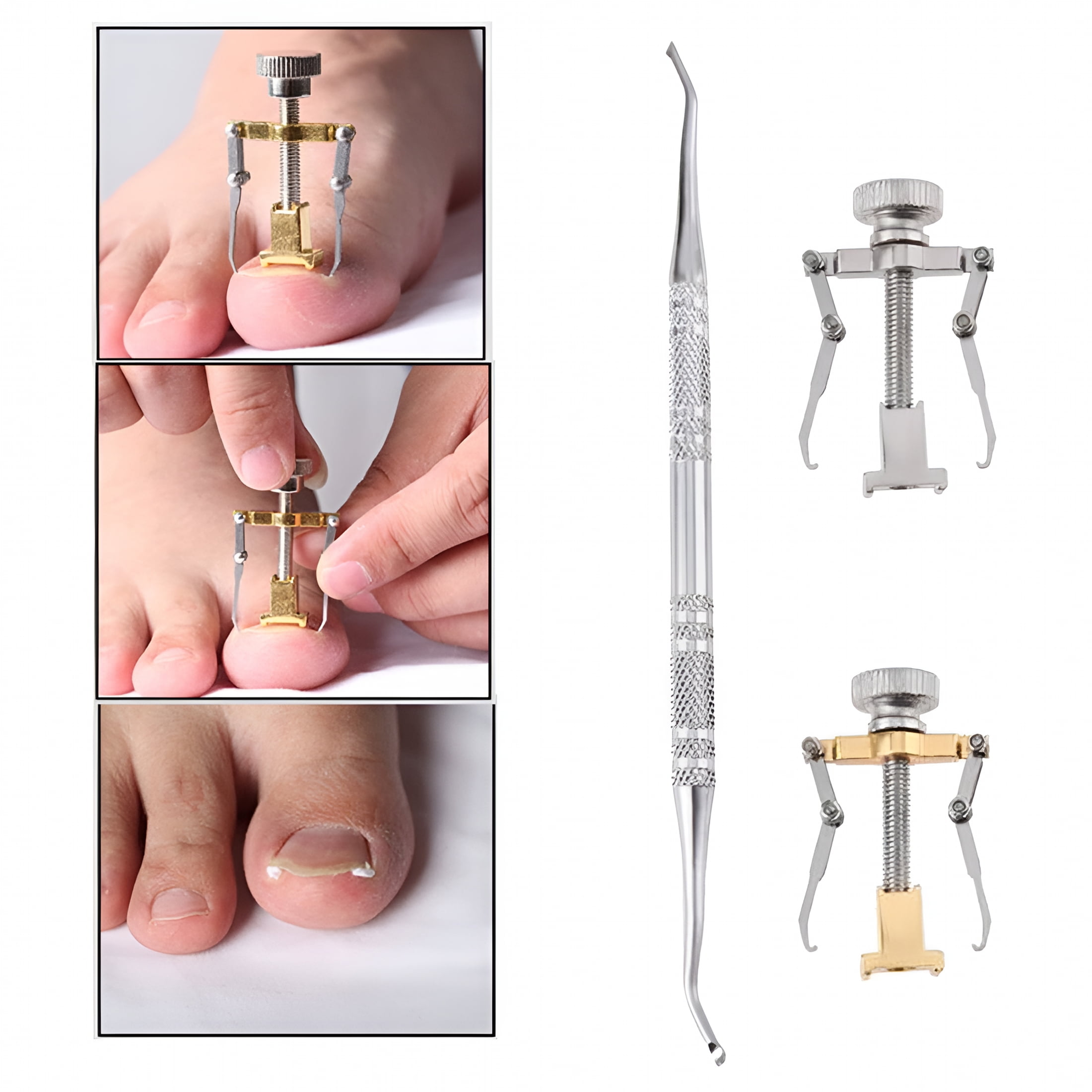 XIRQI Paronychia Therapy Ingrown Toenail Lifter and Correction Tool ...