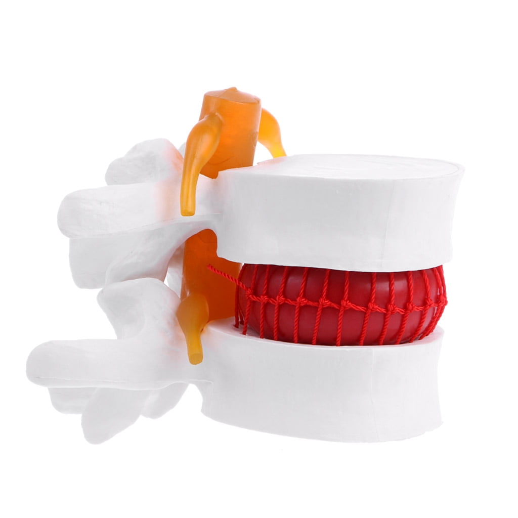 YROHGKPN Human Anatomical Lumbar Disc Herniation Model Learn Aid ...