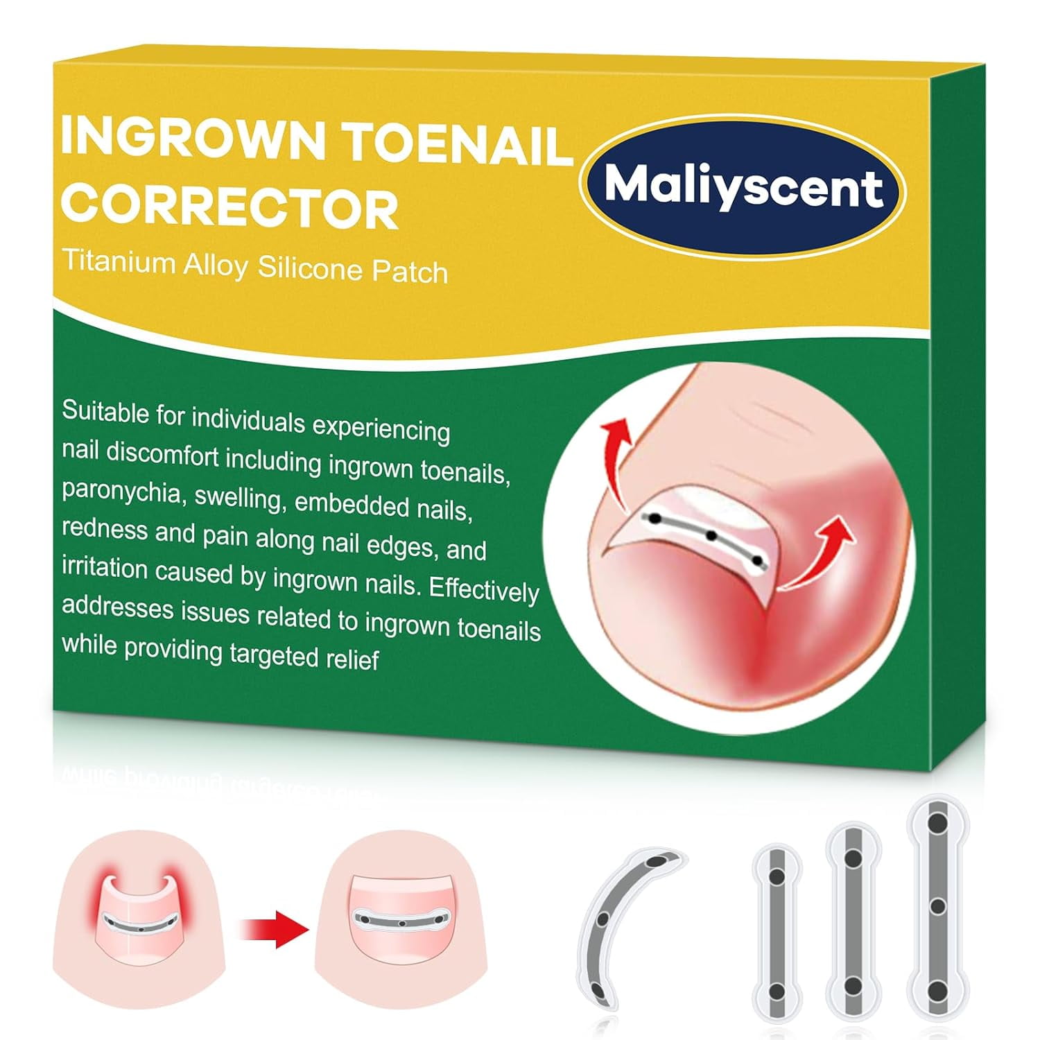 YUCHENG-Titanium Alloy Ingrown Toenail Corrector New Version Ingrown ...