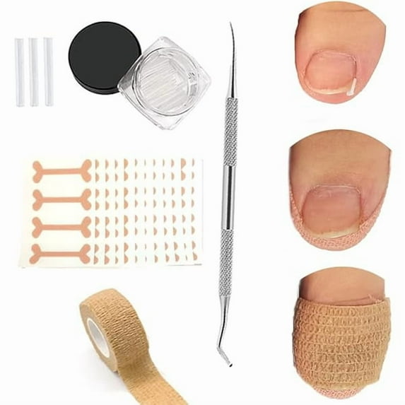 ZLCIngrown Toenail Treatment, Removal Kit, 50pcs Transparent Ingrown ...