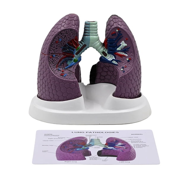 Zeiwohndc Normal and Pathological Lung Anatomy Model Teaching Tool for ...