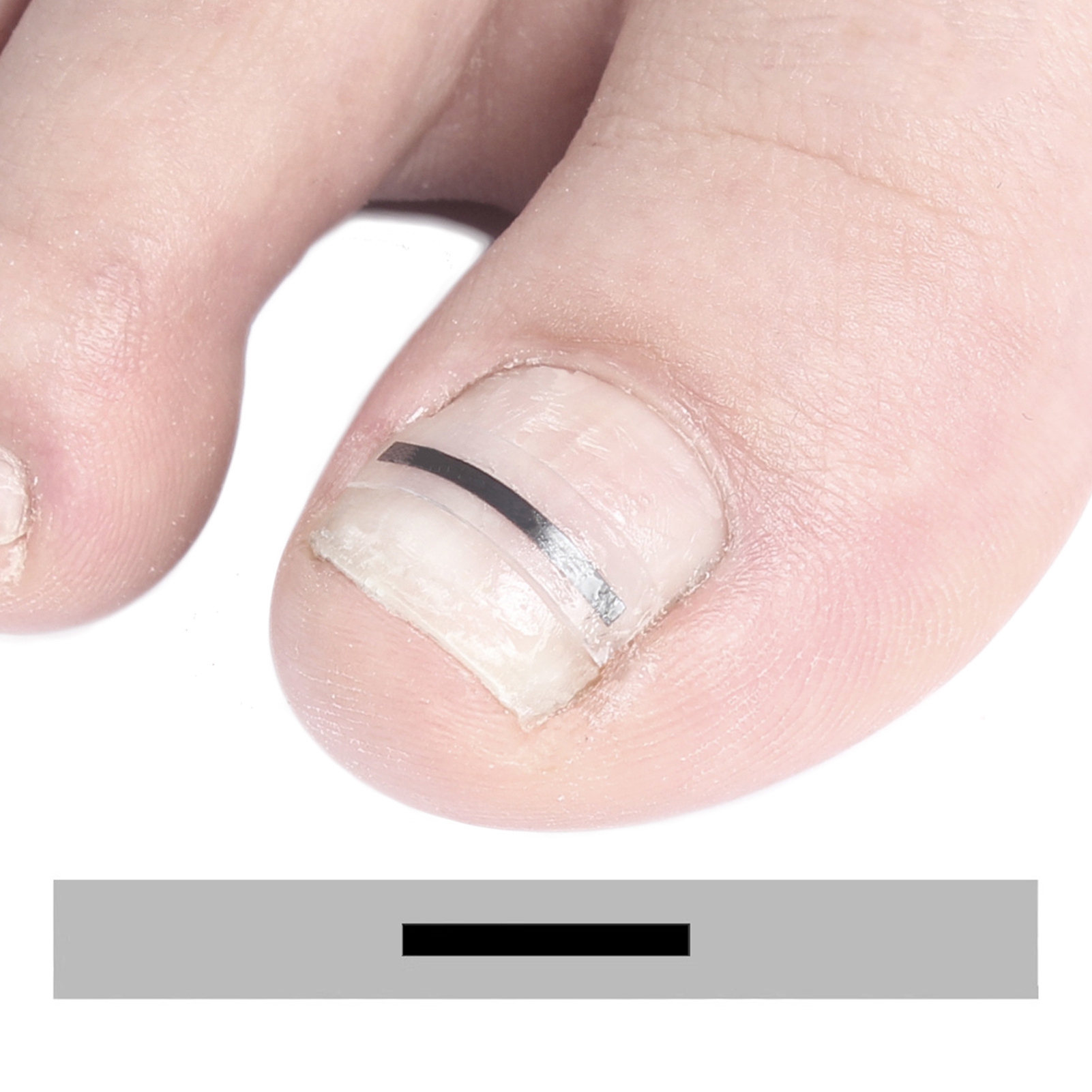 ZhuWa Clearance Toenail Corrector, Titanium Alloy Ingrown Toenail ...