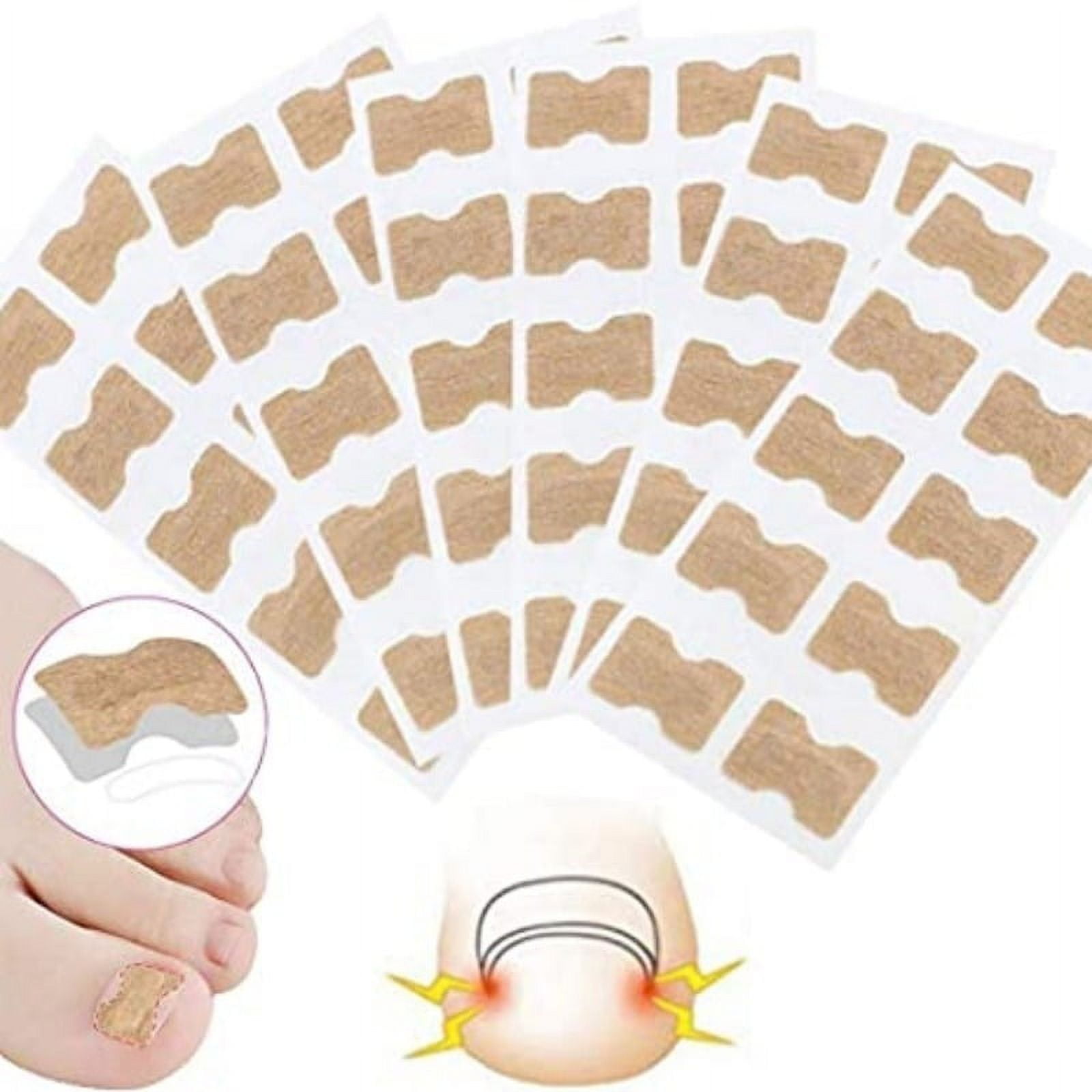 iKeener Ingrown Toenail Corrector Stickers, 100 pcs Adhesive Nail ...