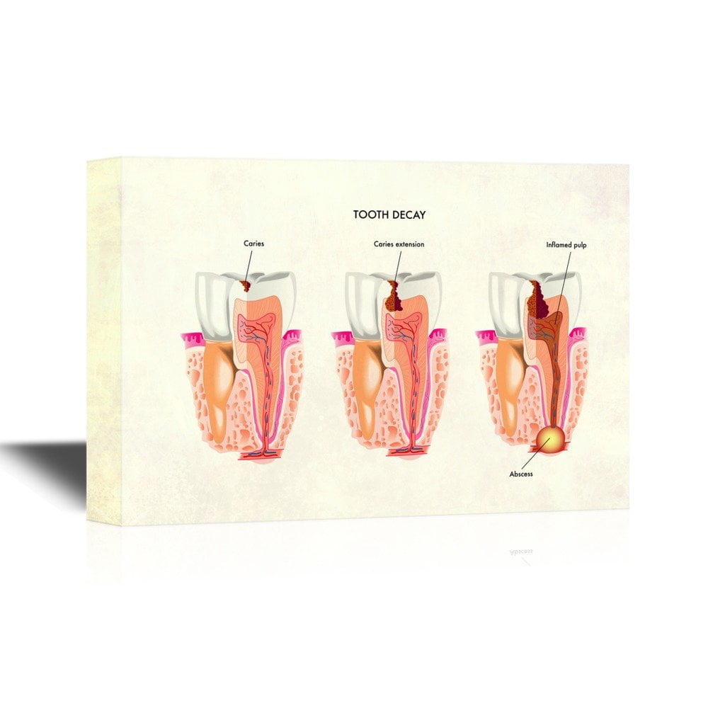 wall26 - Canvas Wall Art - Tooth Decay Diagram - Gallery Wrap Modern ...